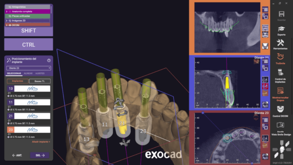 Productos - Pérez Giugovaz - Librerias STL para Exocad