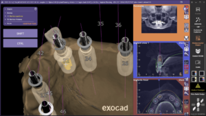 exocad - Pérez Giugovaz